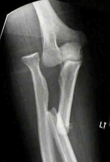 Monteggia Fracture - Orthopedics - Medbullets Step 2/3